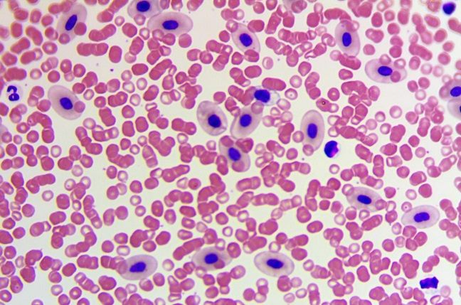 Hai trẻ trong một gia đình tử vong vì bệnh Whitmore | baotintuc.vn