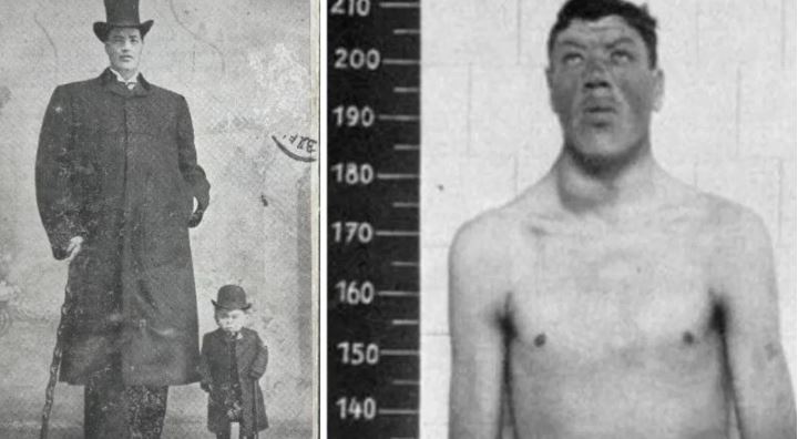 Người duy nhất trên thế giới từ người lùn hóa thành khổng lồ | baotintuc.vn